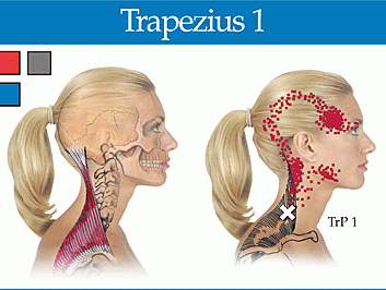 Trapezius trigger point - Orleans Core Elements